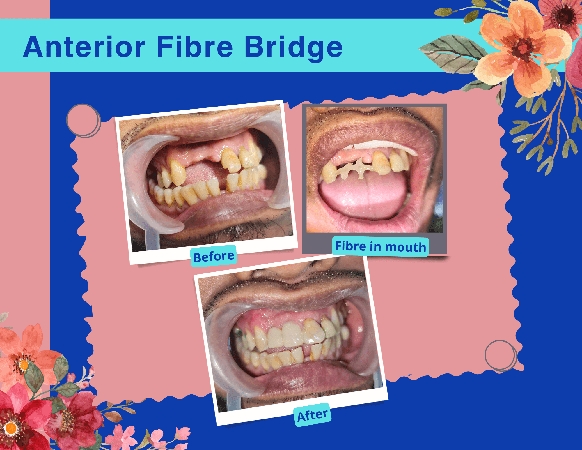 Post Care Instructions After Doing A Fibre Bridge