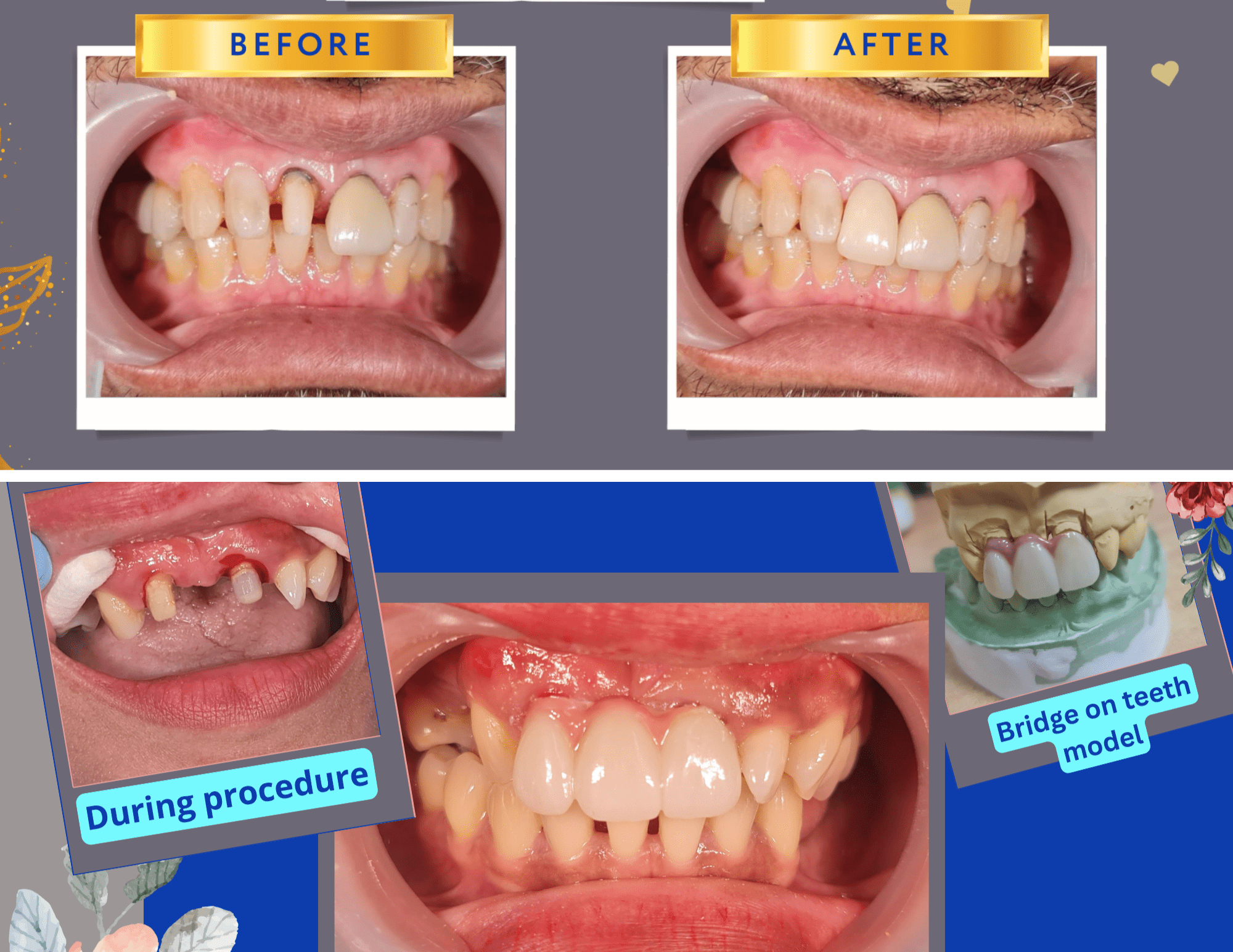 Your temporary crown / bridge care instructions