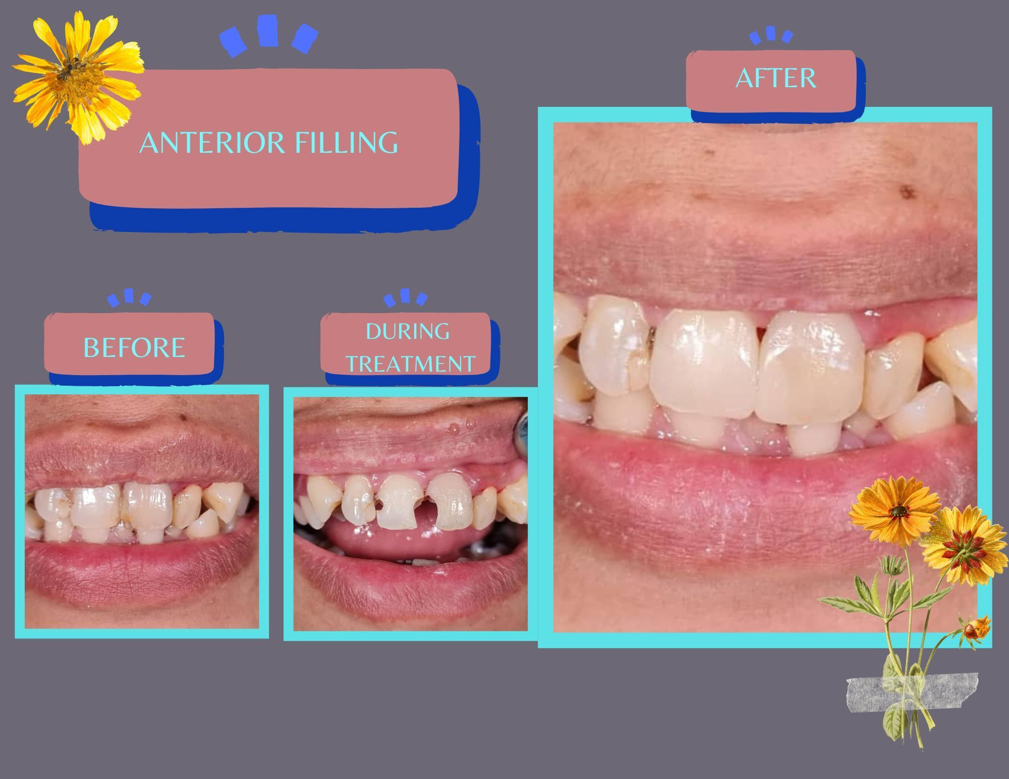 Post-Filling Dental Care