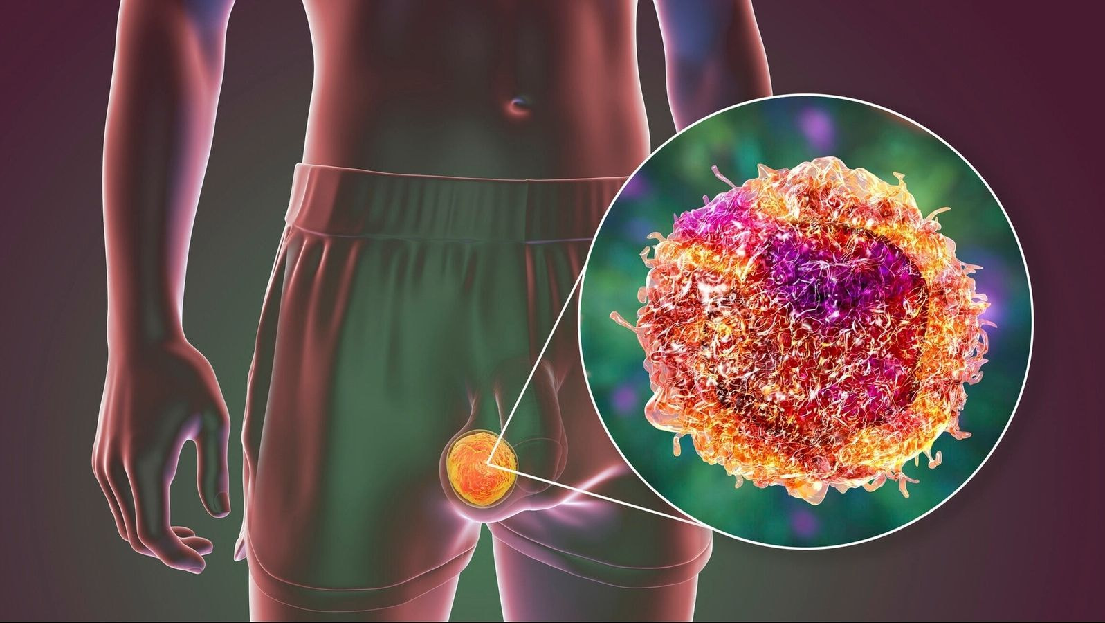 Testicular Cancer 101 Symptoms Types Stages And Treatment